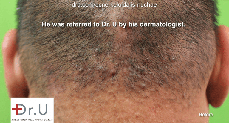 Video- Los Angeles Acne Keloidalis Nuchae Laser Treatment Cure By Dr U