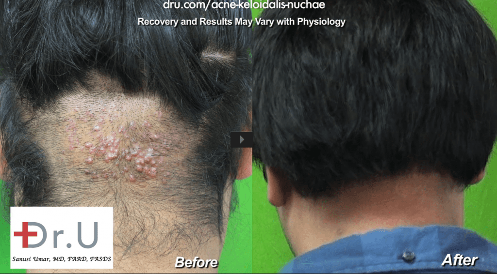 Video: Dr. U AKN Back of Neck Razor Bumps Removal Surgery Results