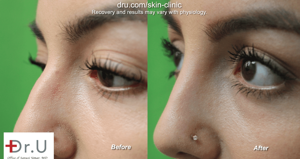 Video: Bump on the Nose Removal - Radiesse Injection by Dr. U
