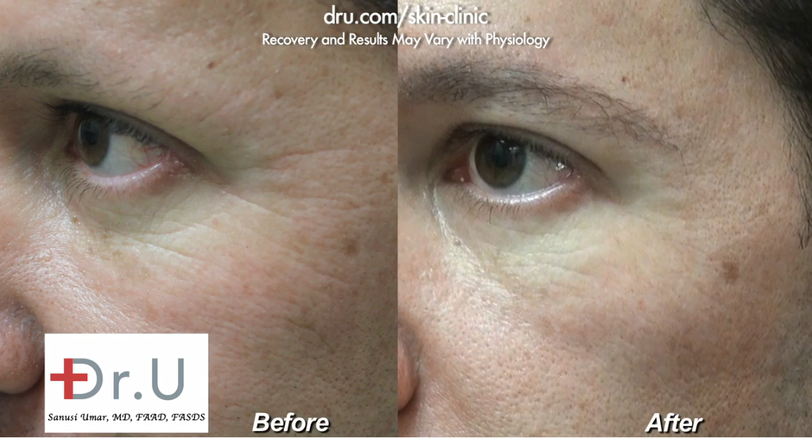 Crow’s Feet Treatment Archives - Dr. U Hair & Skin Clinic | FUE Hair ...