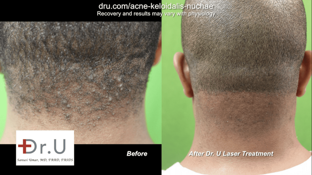 Dr U Clinic AKN Razor Bump Laser Removal Results In Los Angeles