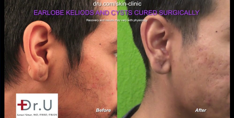 Patient Results: Scar & Keloid Treatment Archives - Dr. U Hair & Skin ...