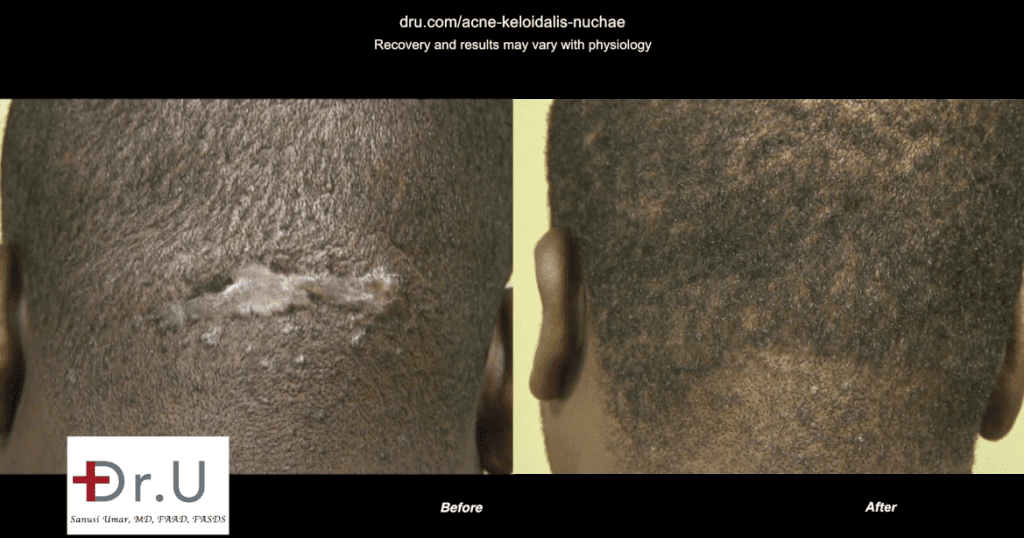 Acne Keloidalis Nuchae Removal with Trichophytic Excision and Closure