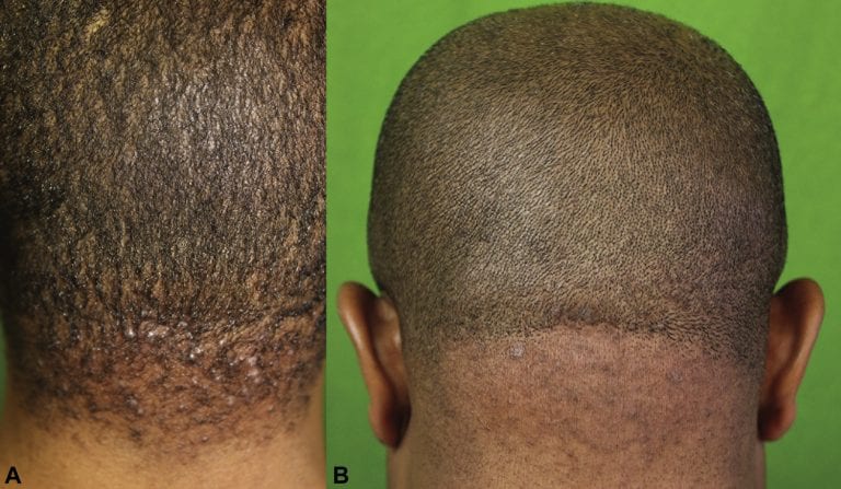 Dr.U’s Selective Treatment Approach For Acne Keloidalis Nuchae Laser ...