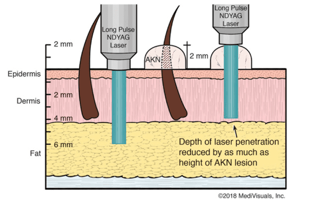 Dr.U’s Selective Treatment Approach For Acne Keloidalis Nuchae Laser ...