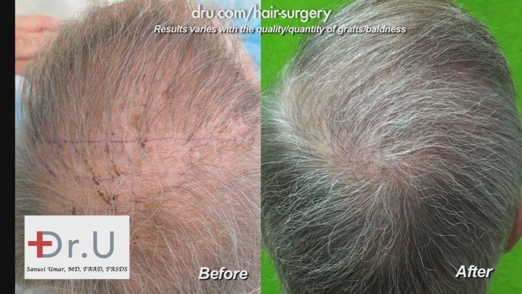 Video - Dr.UGraft BHT Repairs Bad Hair Plug Results and Baldness