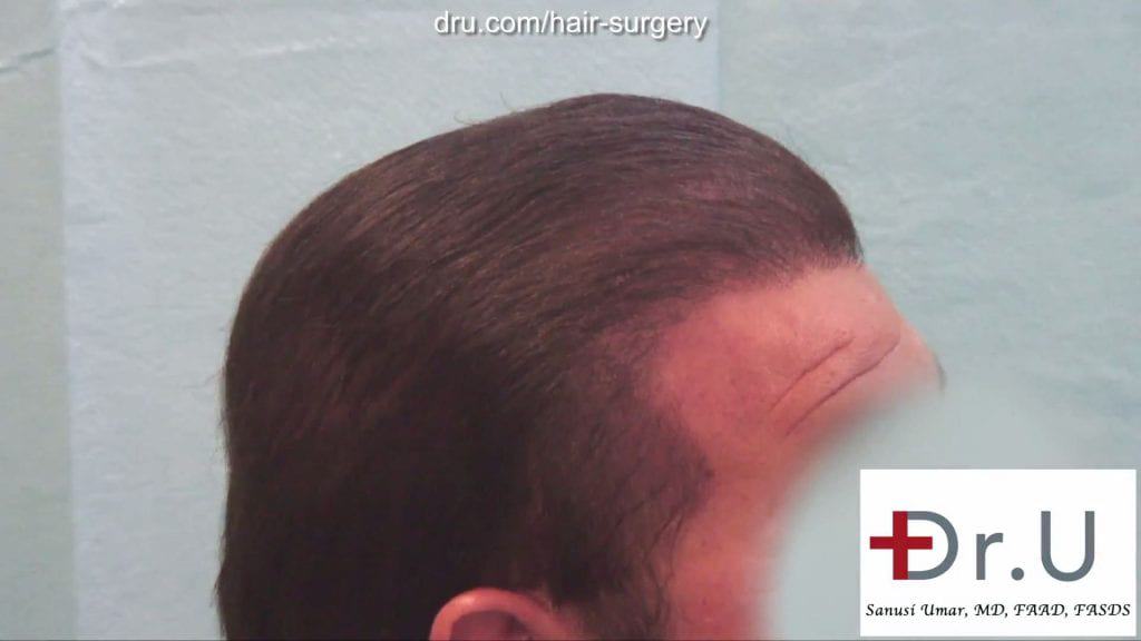 Video - Juri Hair Flap Surgery Problems Fixed by Dr.UGraft FUE