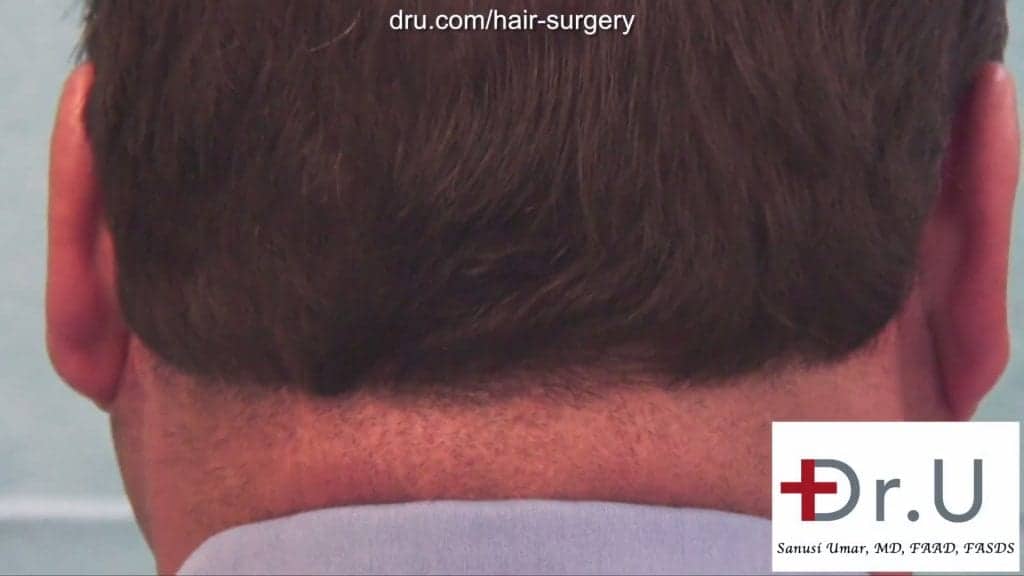 Video - Juri Hair Flap Surgery Problems Fixed by Dr.UGraft FUE