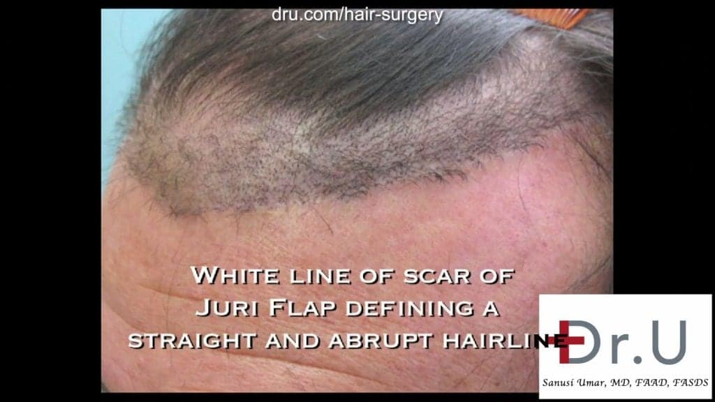 Video - Juri Hair Flap Surgery Problems Fixed by Dr.UGraft FUE